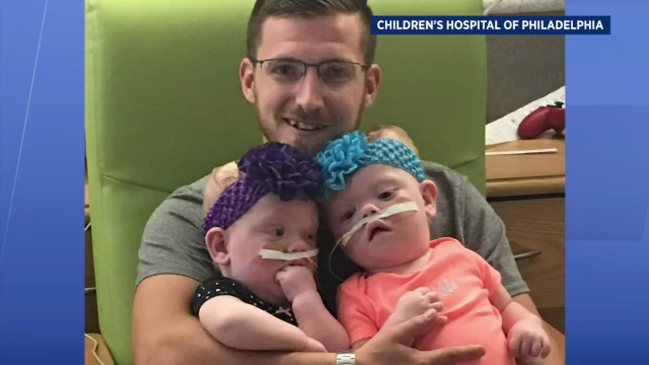 Conjoined twins thriving months after risky surgery