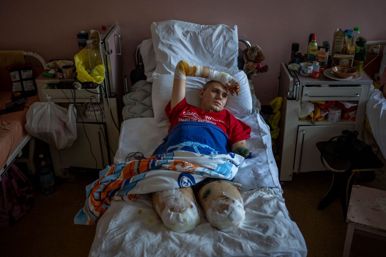 In Ukraine, limbs lost and lives devastated in an instant