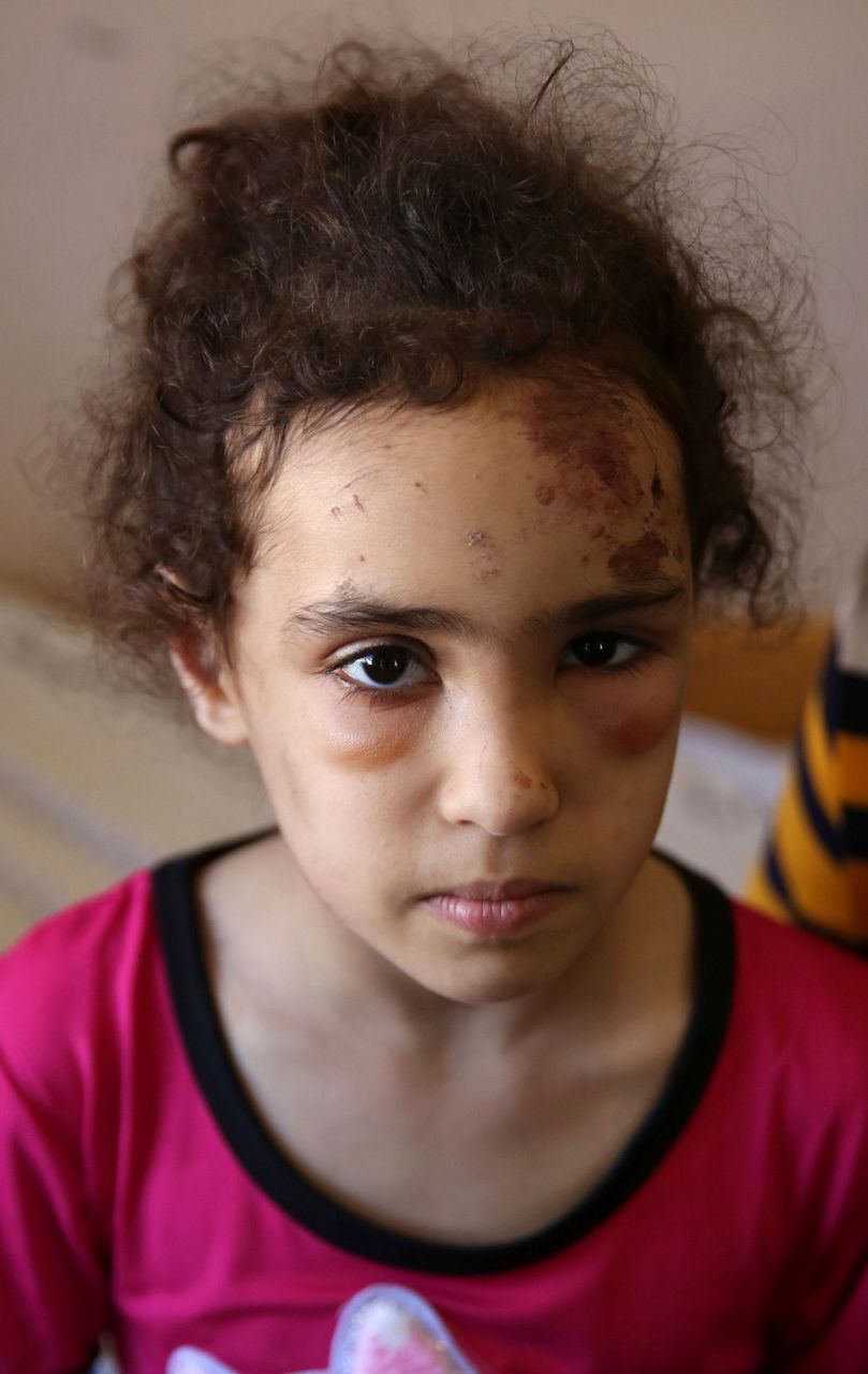 Gaza children bearing the brunt in Israel-Hamas conflict