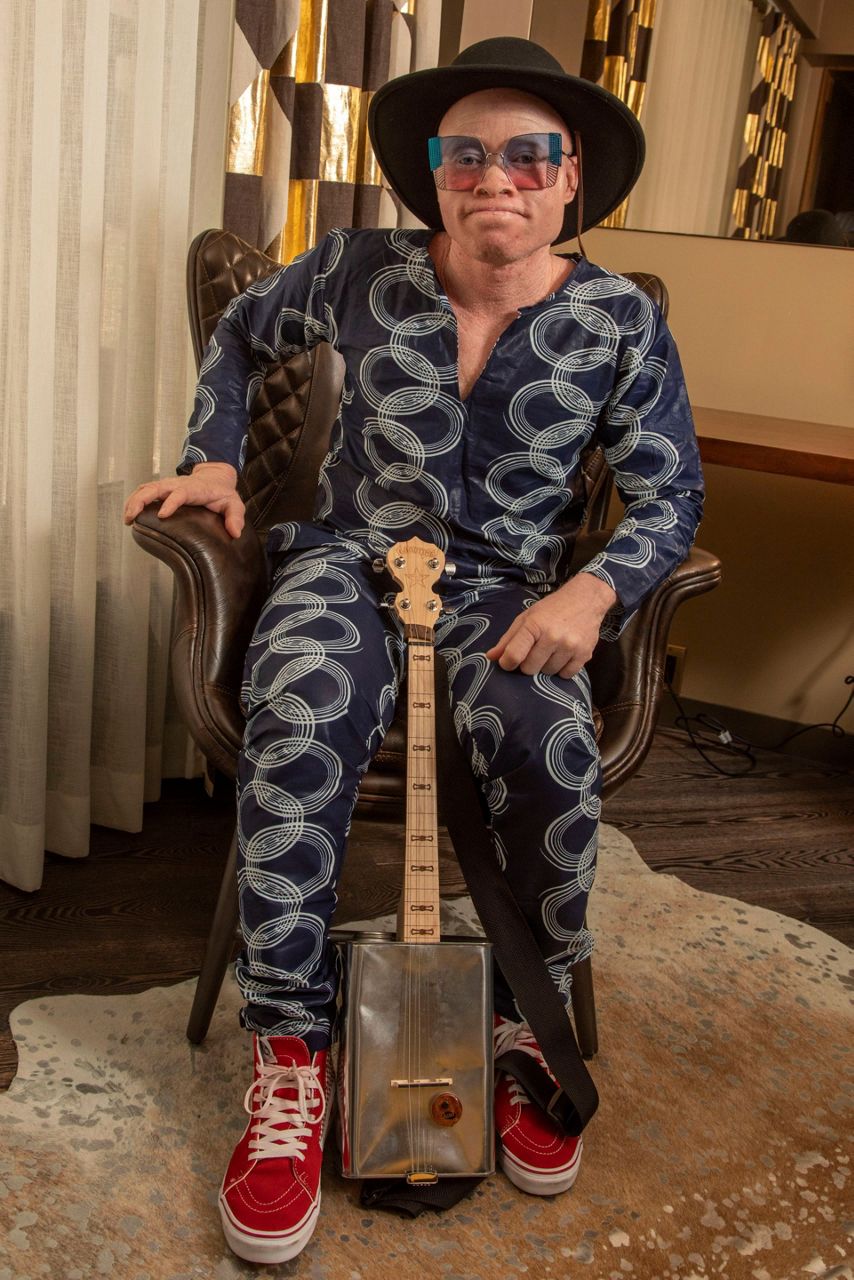 With albinism, musician Lazarus finds light in the darkness