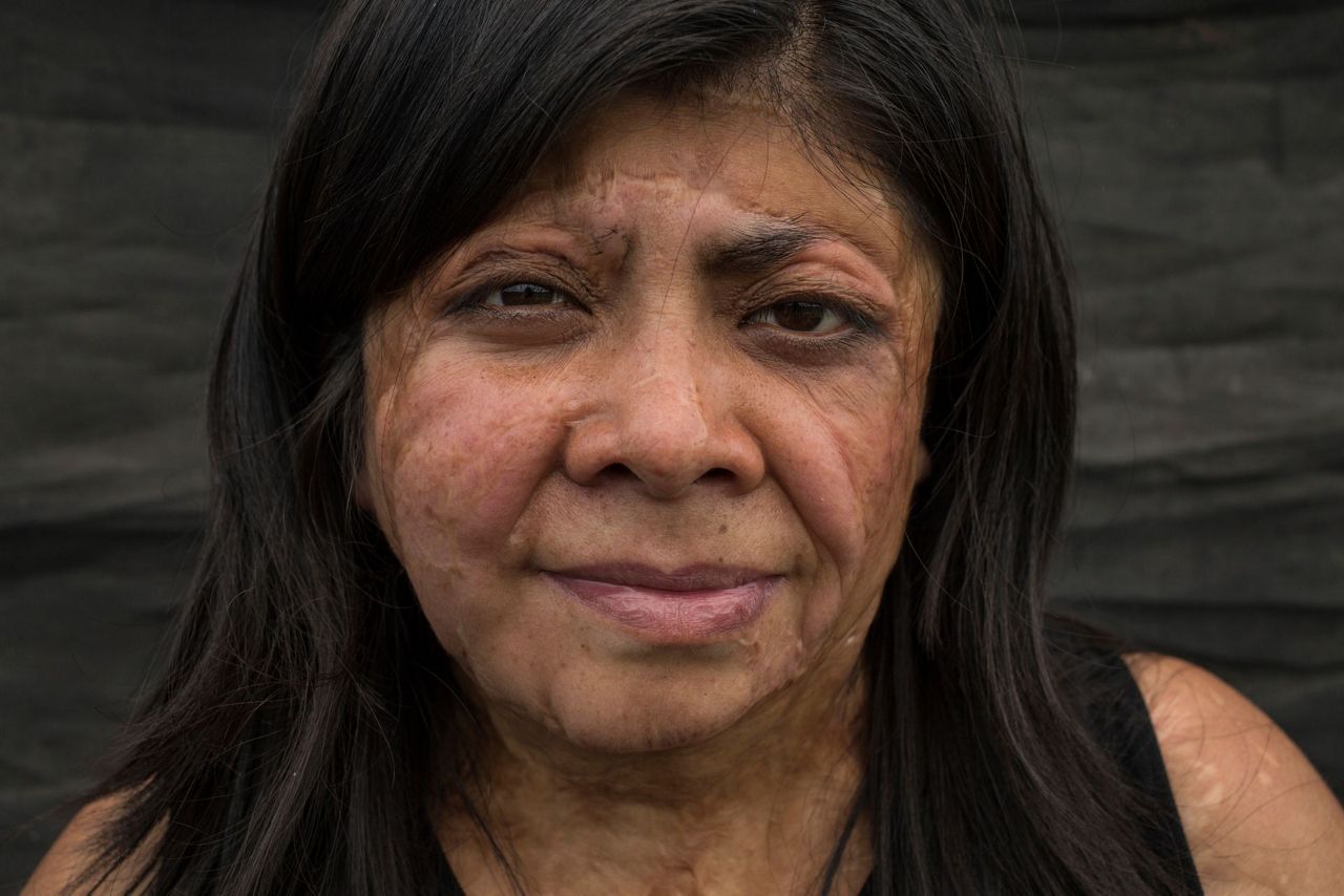 Survivors of acid attacks in Mexico unite to push for change