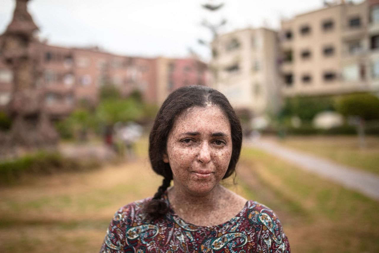 When light is lethal: Moroccans struggle with skin disorder