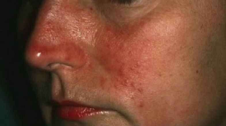 16 Million Americans Have Some Form of Rosacea; Are You One of Them?