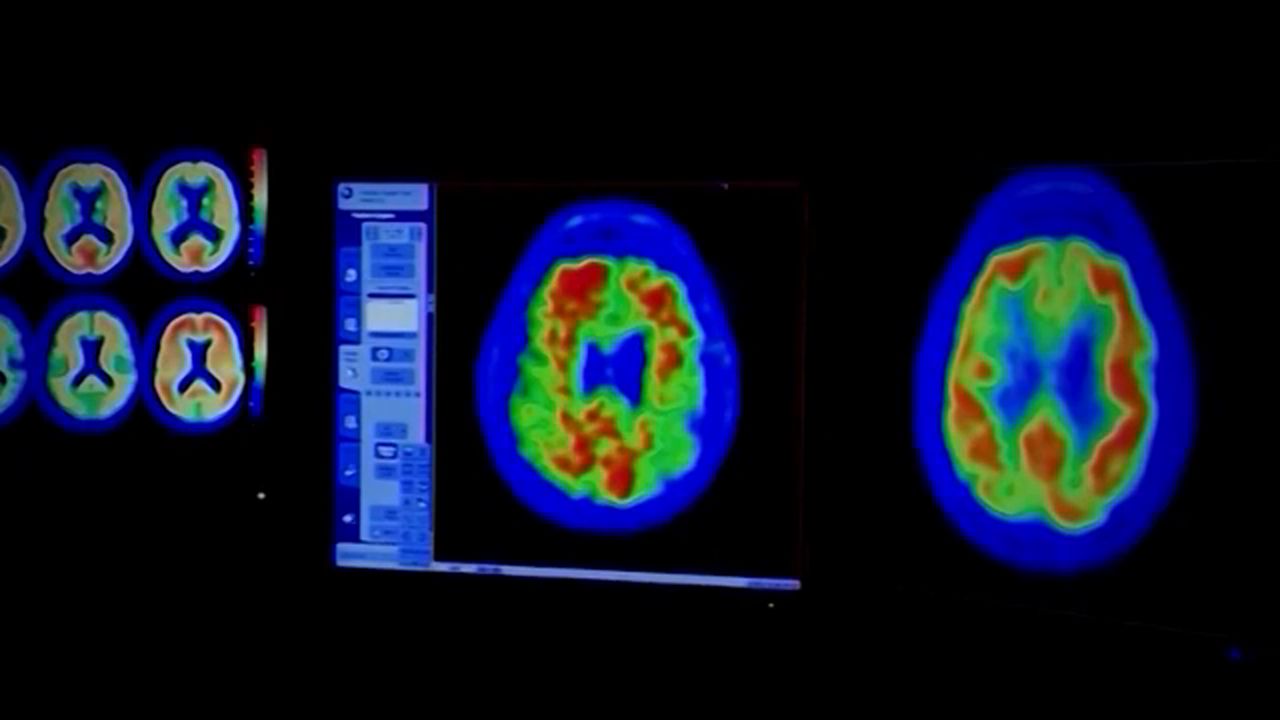 Free Virtual Check-Up's Raise Awareness for Alzheimer's Disease