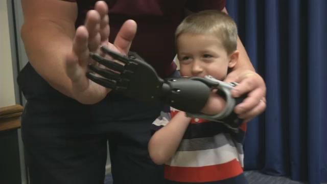 New helping hands in the grasp of three kids born without