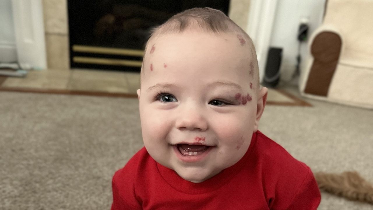 The faces of PHACE Syndrome