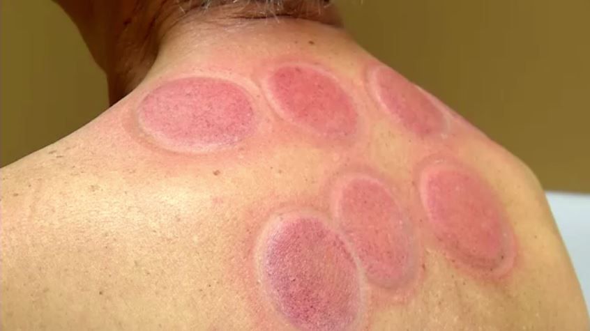 Cupping: It's Not Just for Olympians