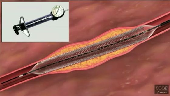 FDA Approved First Dissolvable Stent for Clogged Arteries