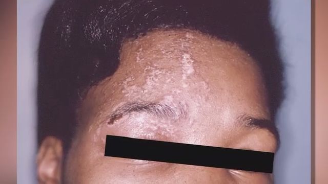 Trial Study to Examine Effectiveness of Treating Shingles with Antivirals