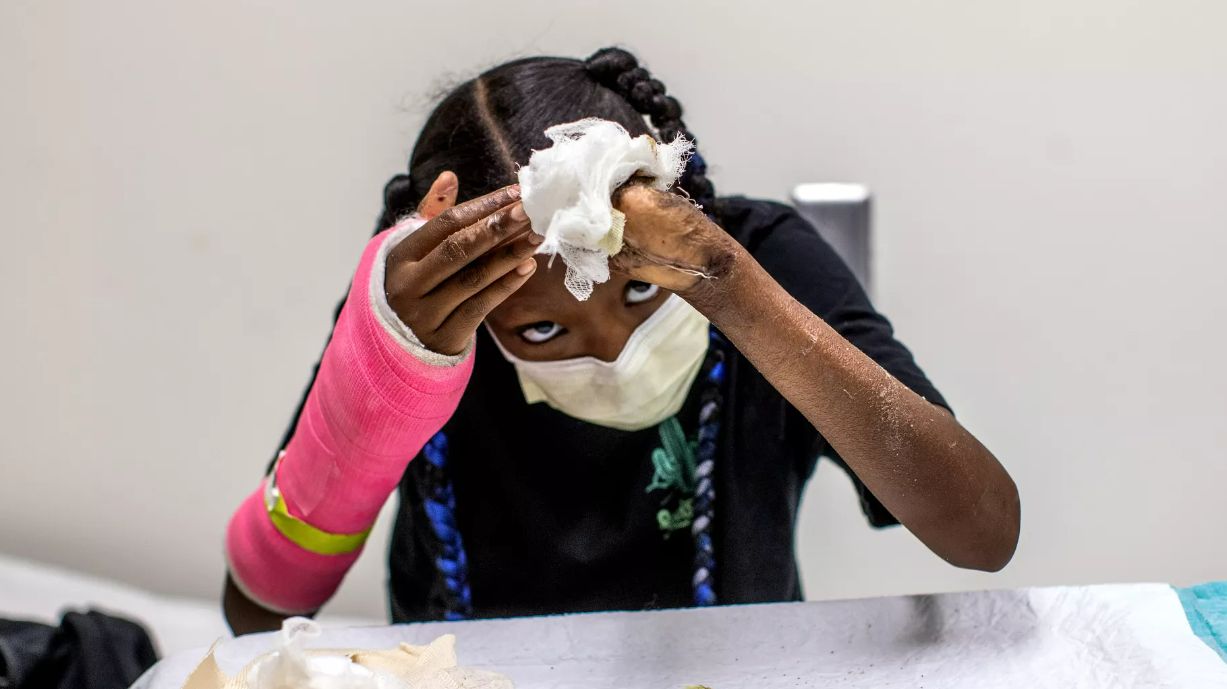 LA teen shares courage after fireworks explosion injury