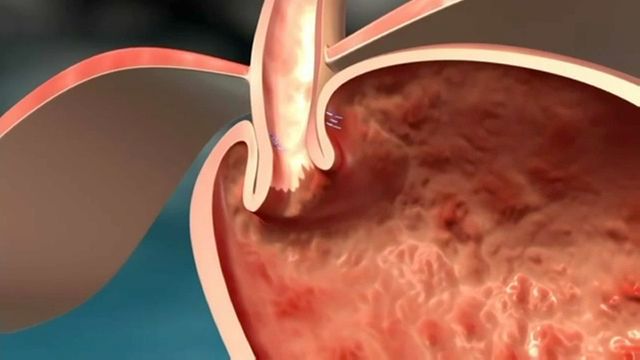 New Procedure Keeps Reflux Disease in Check