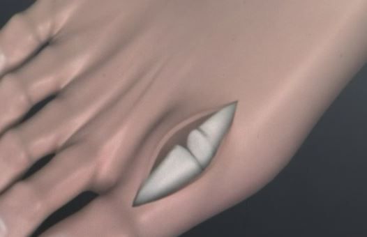 How a Toe Implant Gets Patients Back on Their Feet