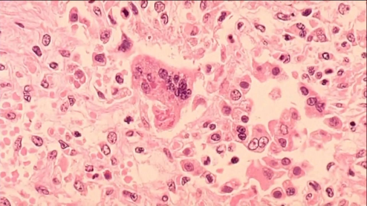 Measles Outbreak Town Hall