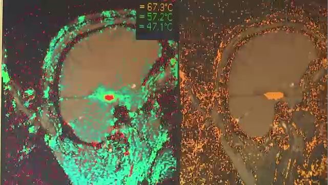 Growing More Popular, Treatment for Epilepsy Burns Brain Tissue