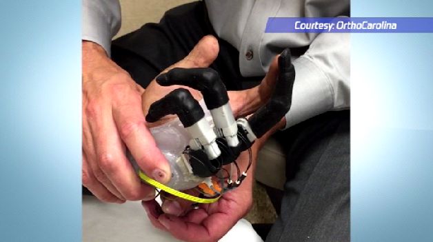 Charlotte Surgeons Develop Prosthetic Hand with Individual Finger Control