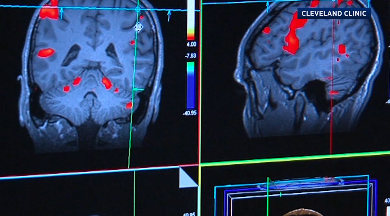 Cleveland Clinic launches first-of-its-kind brain study