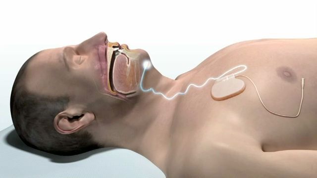New Sleep Apnea Treatment Stimulates Relief