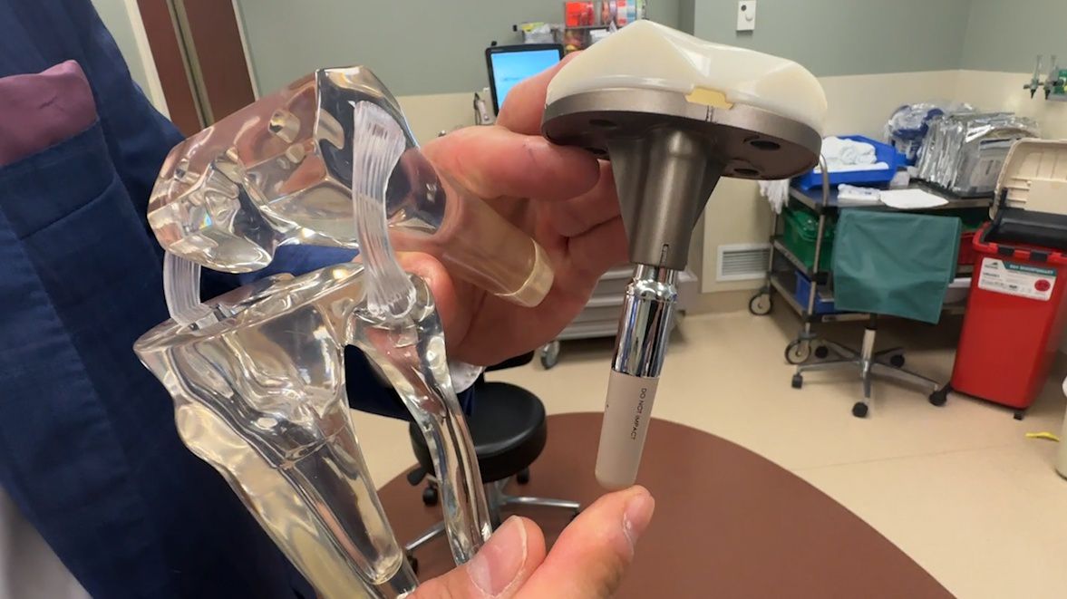 Doctor sees better results with Smart Knee replacement