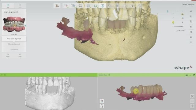 Dental Scans Map Out Clearer Path for Implant Patients