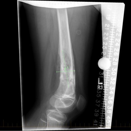 Ewings Sarcoma X Ray