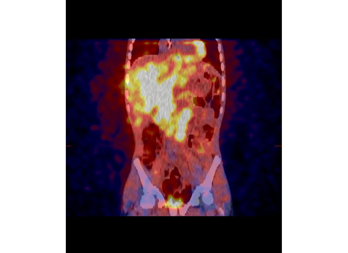 MIBG Scan for Childhood Cancer - Together